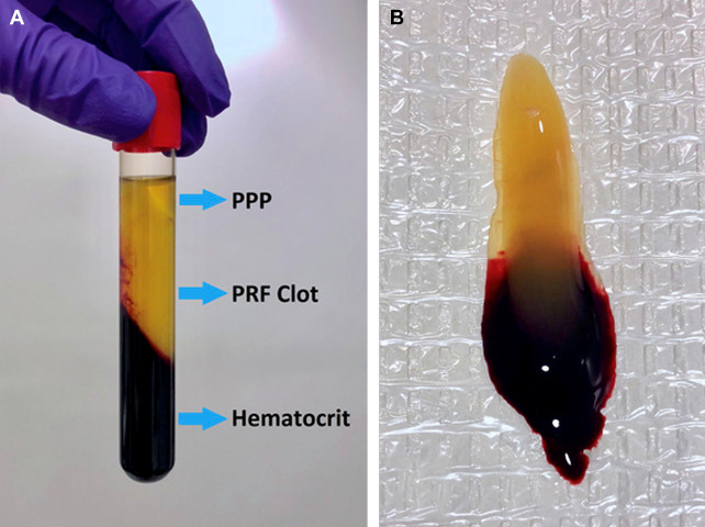 The Benefits of Platelet-Rich Fibrin | PRFCanada